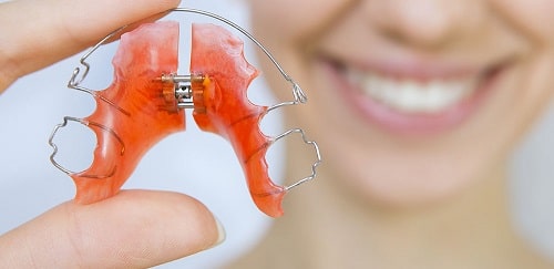 Do Expanders Hurt? | Orthodontists in Buffalo, NY | Free Consultations
